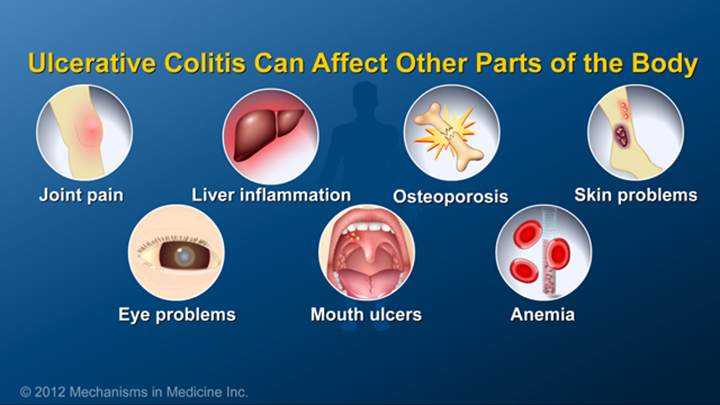Ulcerative Colitis Skin Symptoms Cutaneous Manifestations In