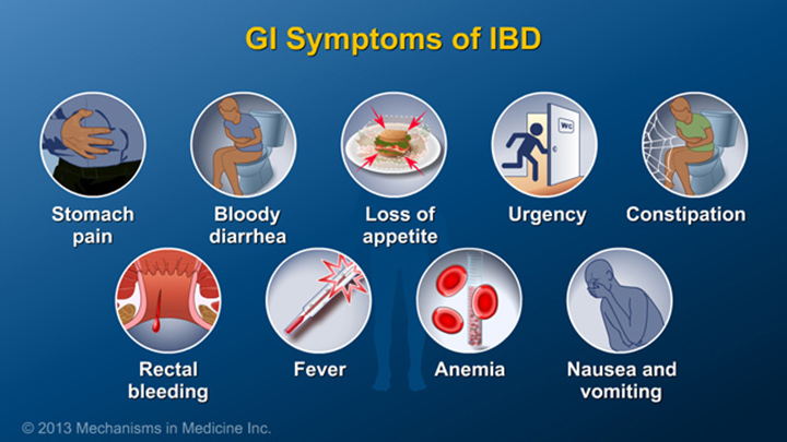 Diagnosing IBD
