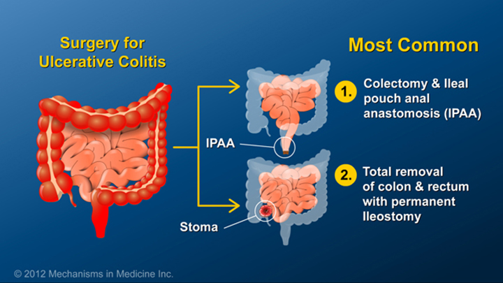 Small Bowel and Large Bowel Surgery for IBD