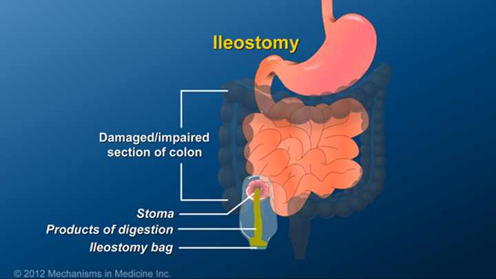 What is an Ileostomy?