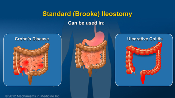 What is an Ileostomy?